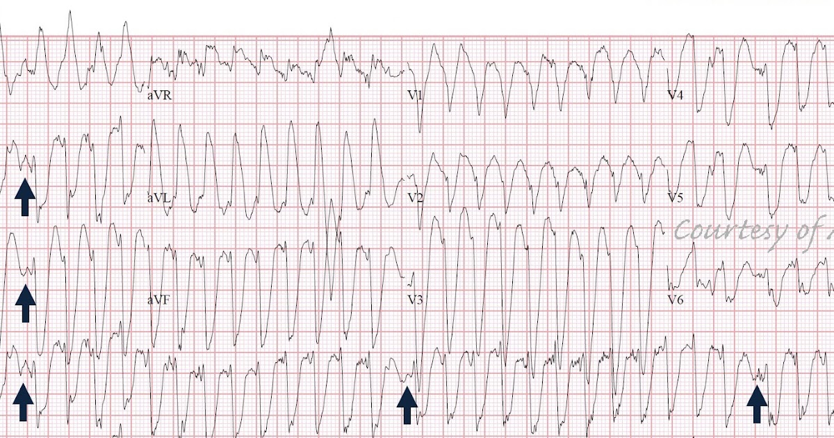 ECG Rhythms: VT or SVT (with aberrancy or fixed BB)?