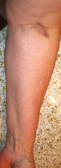 jm's Adventure with Multiple Myeloma: Bruising Due To Low Platelets ...