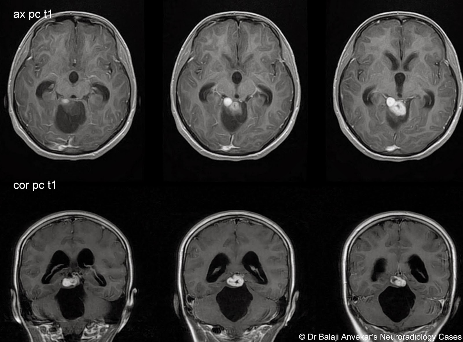 (PPTX) Presentation1.pptx, radiological imaging of hydrocephalus ...