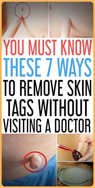 7 Easy Ways to Remove Skin Tags Without Visiting a Doctor - medicine ...
