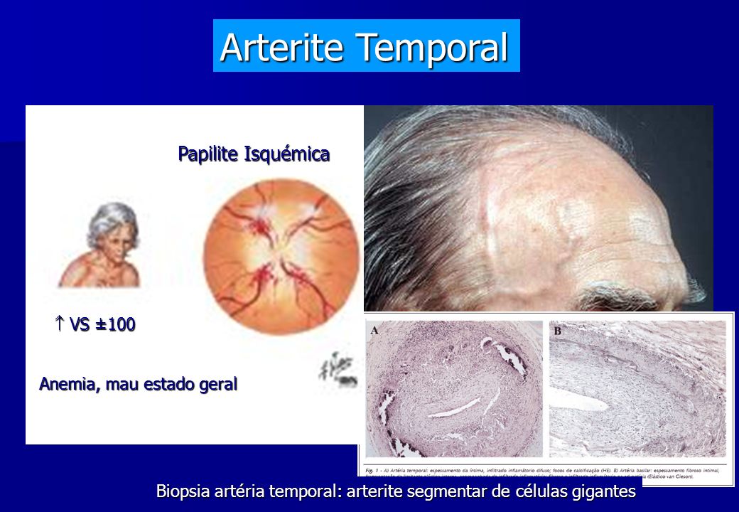 Sintomas De Arterite Temporal - RETOEDU