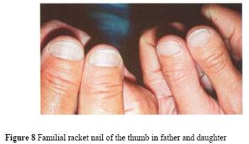 Nail Diseases: Brachyonychia