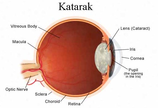 Katarak, Penyebab dan Cara Penanganannya | Pixels by Pixie