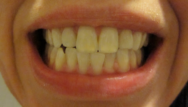 Jessica Jean Myers: Whitening Lightning - Tooth Whitening Review