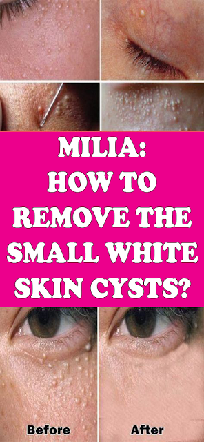 MILIA: HOW TO REMOVE THE SMALL WHITE SKIN CYSTS? | Healthy High