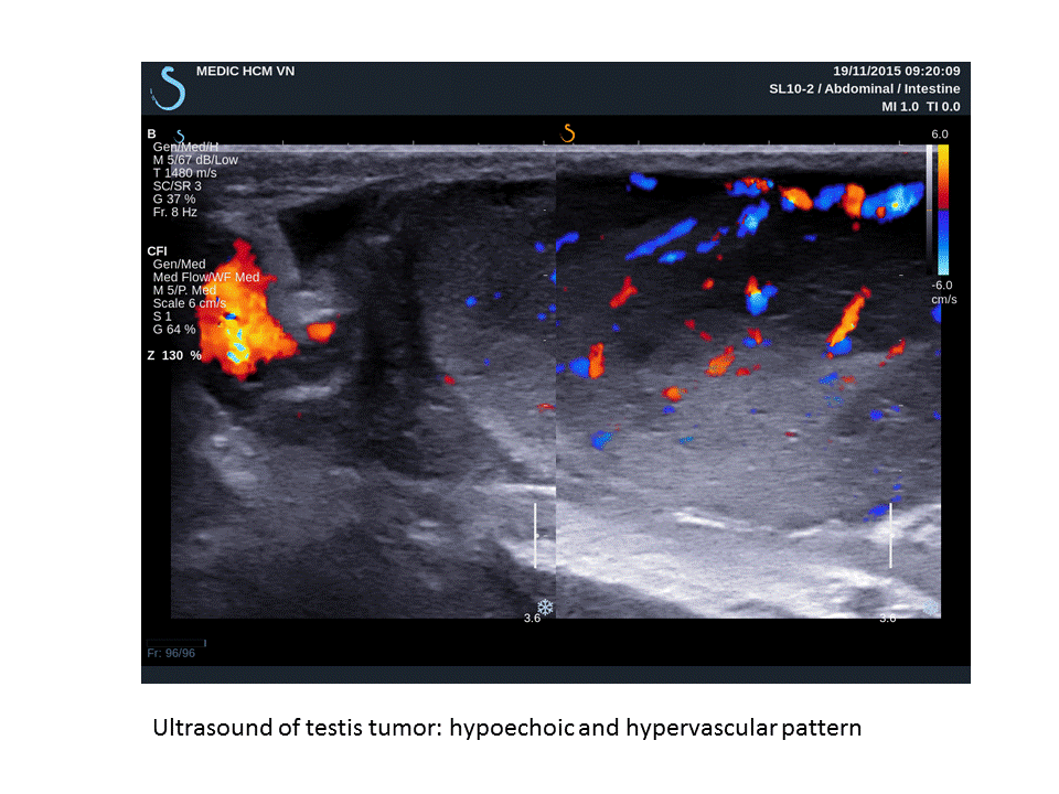 BÀI SOẠN VỀ SIÊU ÂM CHẨN ĐOÁN: NHÂN 03 CA DIFFUSE LARGE B CELL LYMPHOMA ...