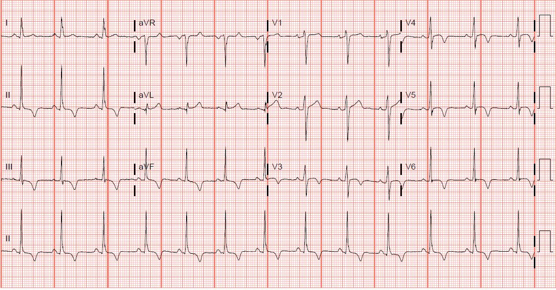 ACLS review: Acute Coronary Syndromes Part 6