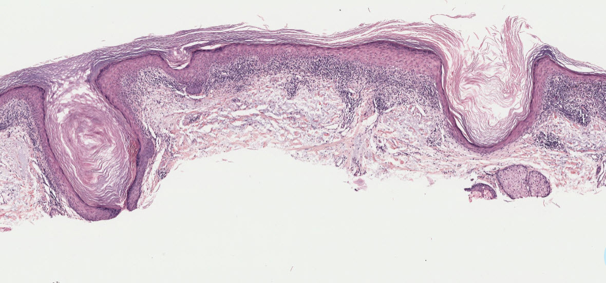 Differential Diagnosis in Dermatopathology: 2014