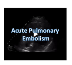 McConnell' Sign: Pulmonary Embolism - Sumer's Radiology Blog