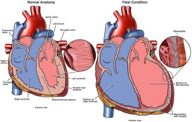 PHARMACO PLUS: Heart Infections