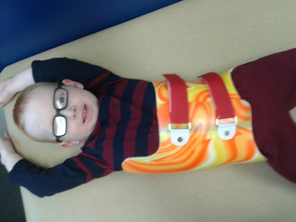 Mason's Spina Bifida Journal: Scoliosis Brace - Night bending brace