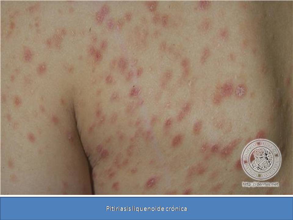 Pitiríase Rosea De Gilbert Causa - RETOEDU
