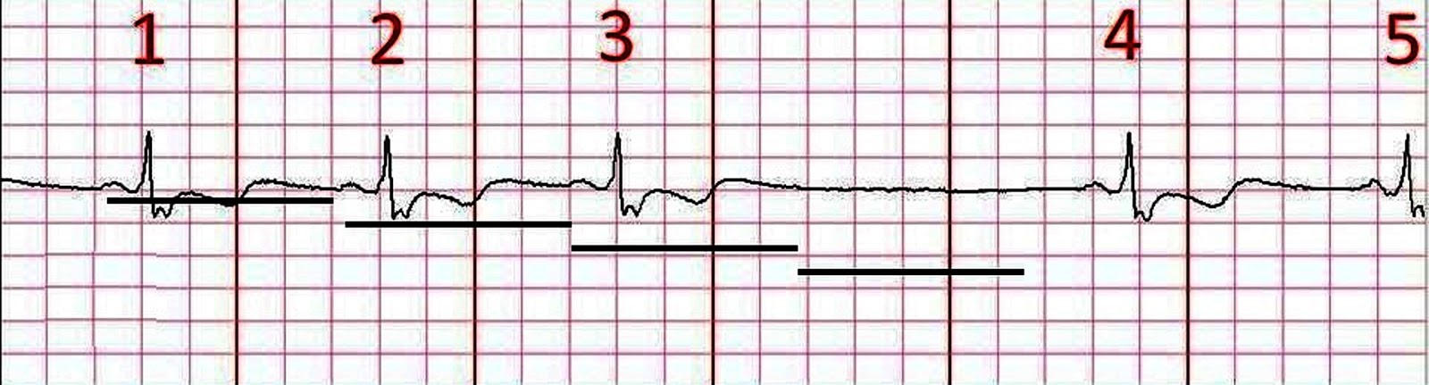 ECG Channel: Sinus arrest or Sinus Pause
