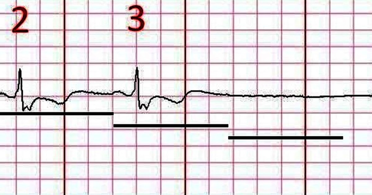 ECG Channel: Sinus arrest or Sinus Pause