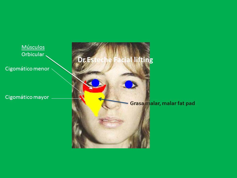 Dr.Esteche | Cirugía Plástica Facial | Cirugía Facial: FACELIFT |19 ...