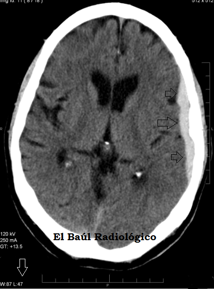 El Baúl Radiológico: NIVEL Y AMPLITUD DE VENTANA EN TOMOGRAFÍA ...