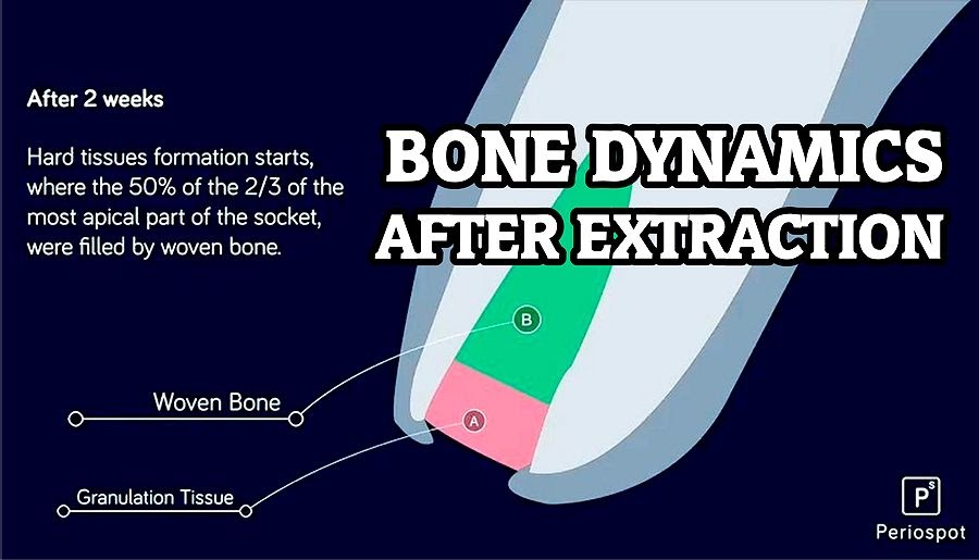 TOOTH EXTRACTION: Bone Dynamics after extraction - Odonto-Tv