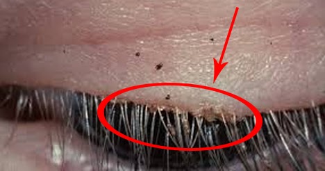 Insects living In The woman's Eyelashes - The Horrifying Close-up Video ...