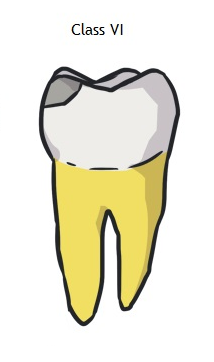 Dentasource: G. V. Black's Classifications of Tooth Decay