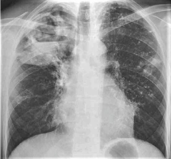 HISTOLOGÍA un enfoque clínico: TUBERCULOSIS