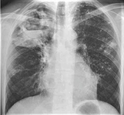 HISTOLOGÍA un enfoque clínico: TUBERCULOSIS