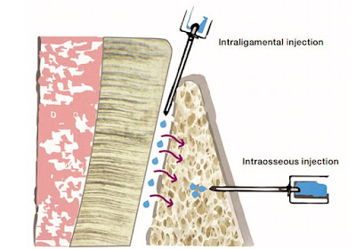 PDF: SUPPLEMENTAL INJECTIONS IN DENTISTRY - Intraligamental ...