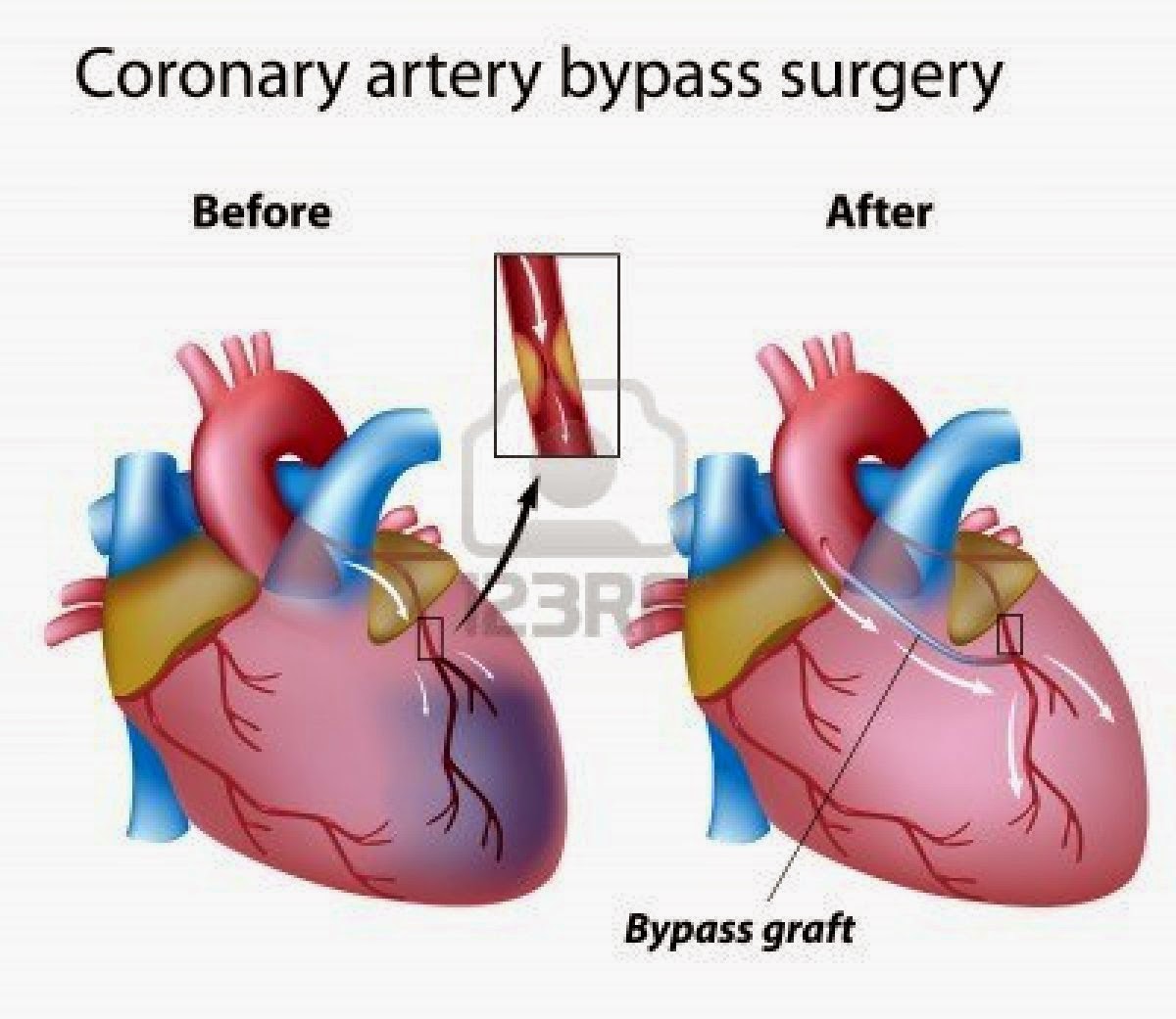 TERAPI MEMBUKA URAT JANTUNG YANG TERSUMBAT | ALHEKMAH.MY - NATURAL SYNERGY