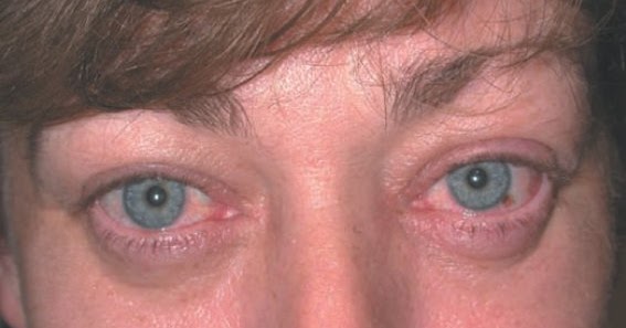 Bacterial Conjunctivitis Vs other causes