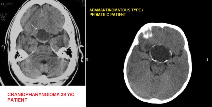 POINT OF VIEW: DX: Suprasellar mass (Hemorrhagic Rathke's Cleft Cyst ...