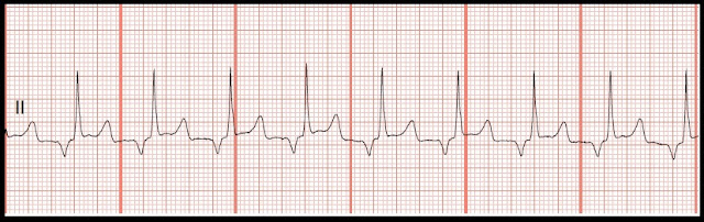 Characteristics of Junctional Rhythms