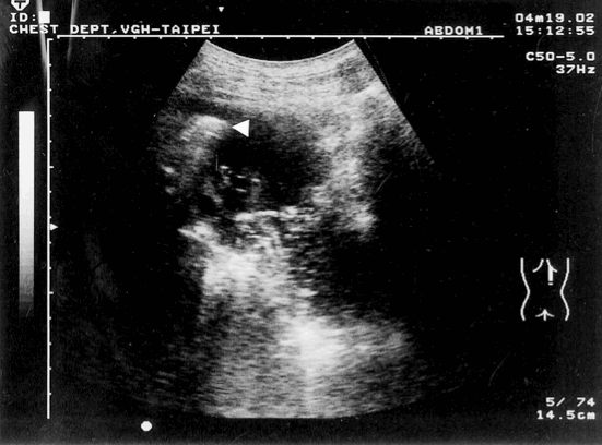 Hydro-Point: Ultrasound sign of air-fluid level in the pleura