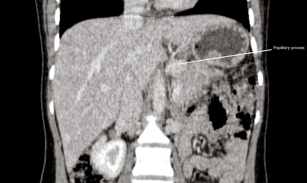 Ultimate Radiology : Pseudolesion : Papillary Process of Caudate Lobe