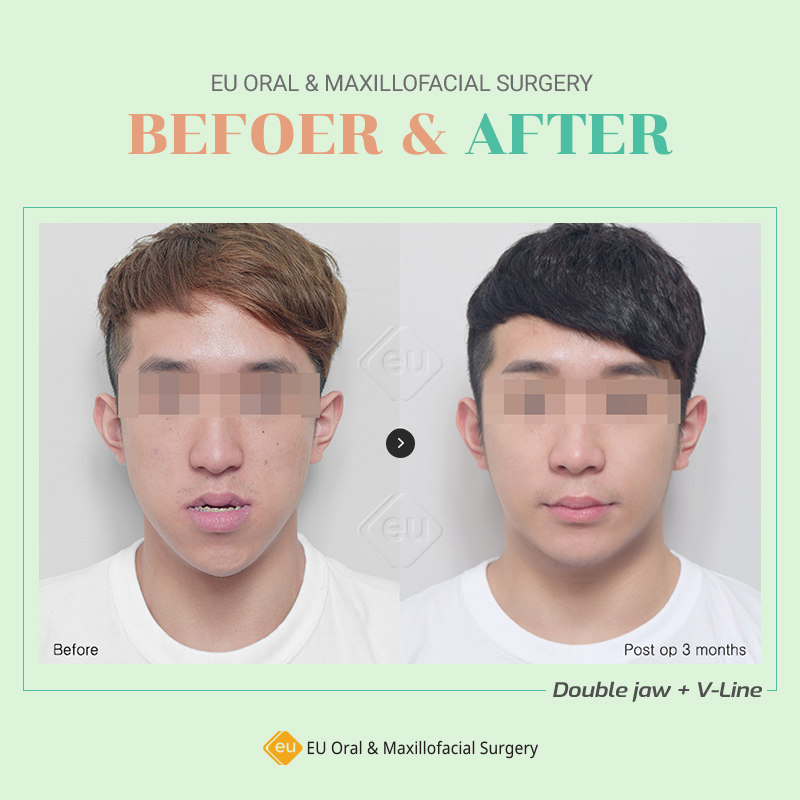 What Is Double Jaw Surgery (Bimaxillary Osteotomy)?