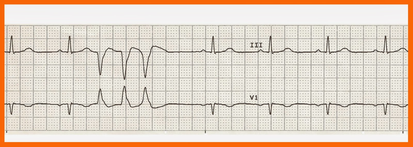 Float Nurse: Practice EKG Rhythm Strips 213
