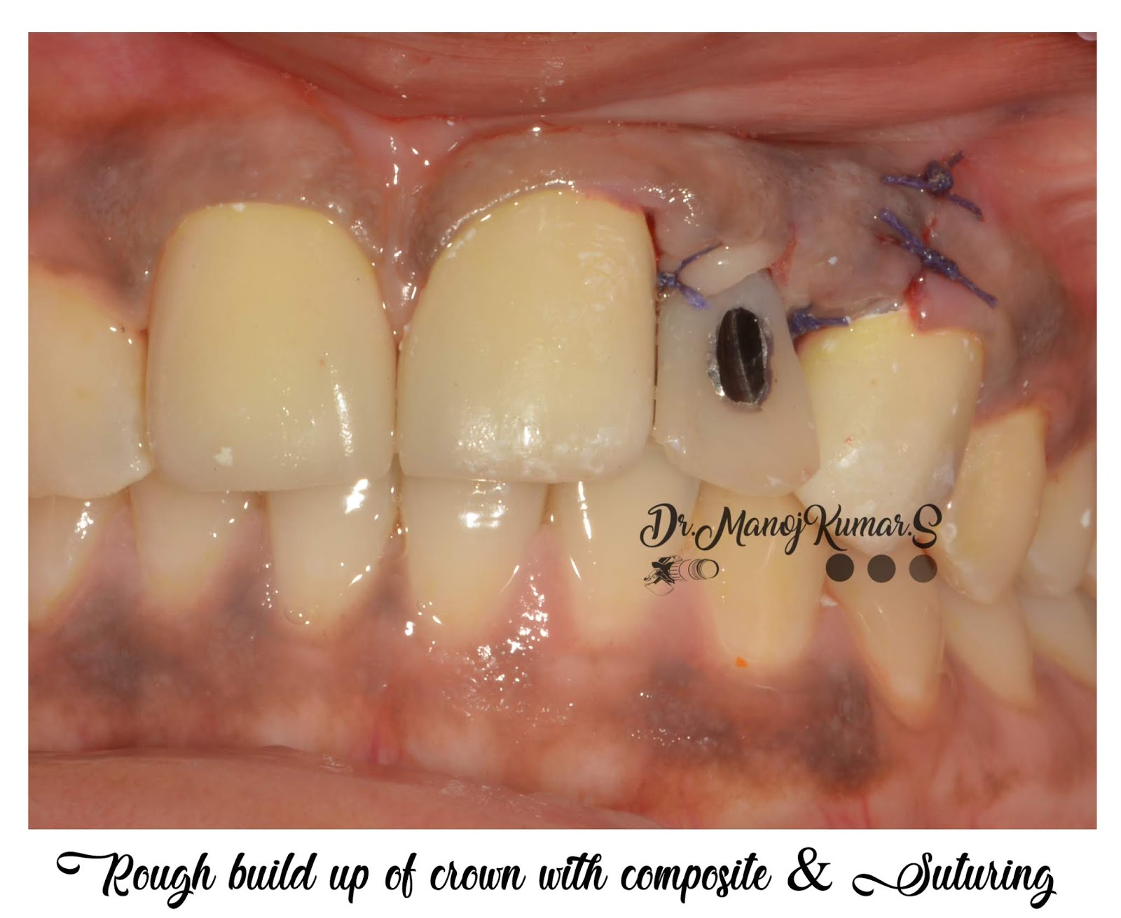 Case 1: Achieving the desired emergence profile - IMPLANT ESTHETICS