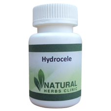Treatment for: Natural Remedies for Hydrocele Treatment