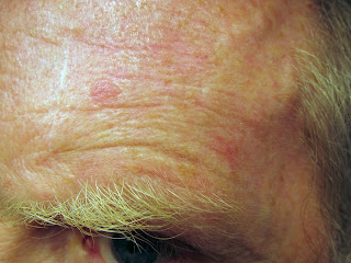 Efudex - Round Two: Day 4 - Starting to see some red areas