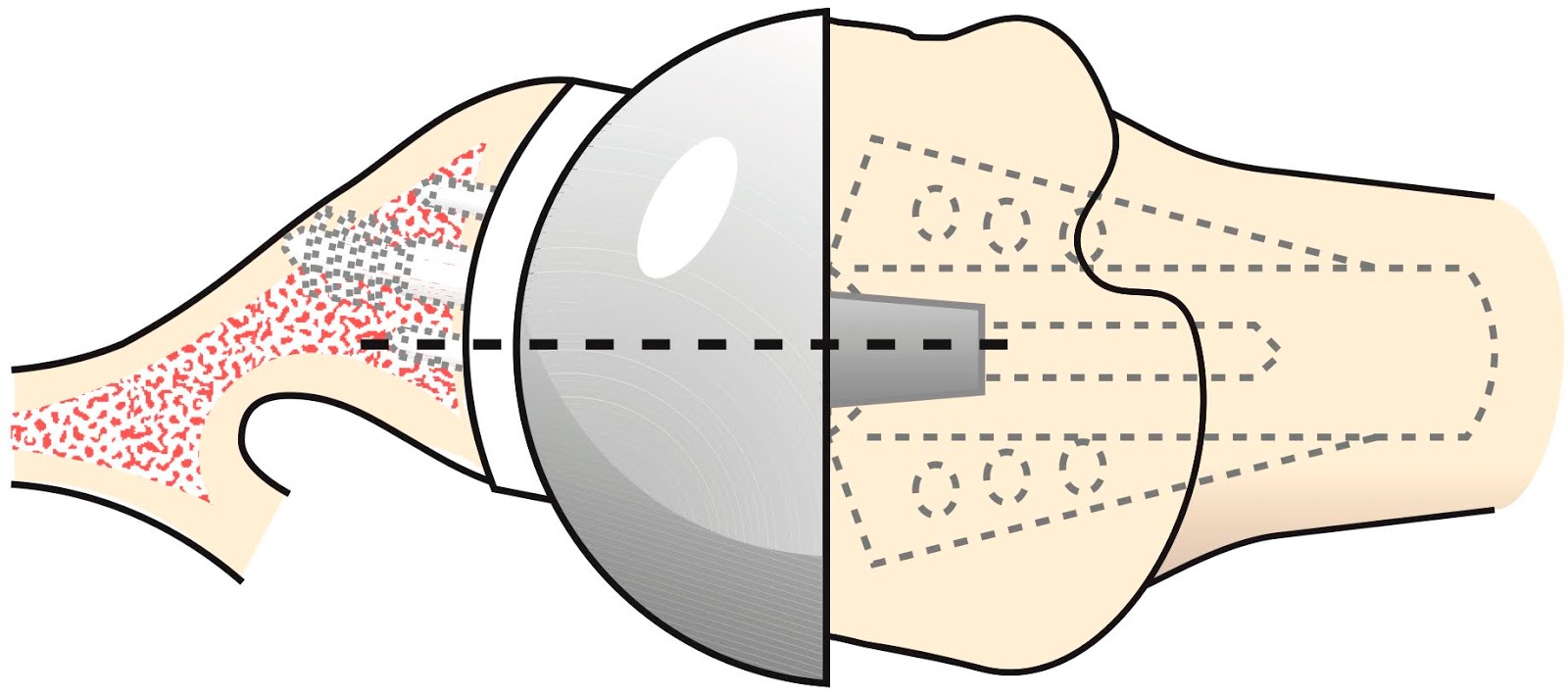 Shoulder Arthritis/Joint Replacement Rotator cuff tears: The normal ...