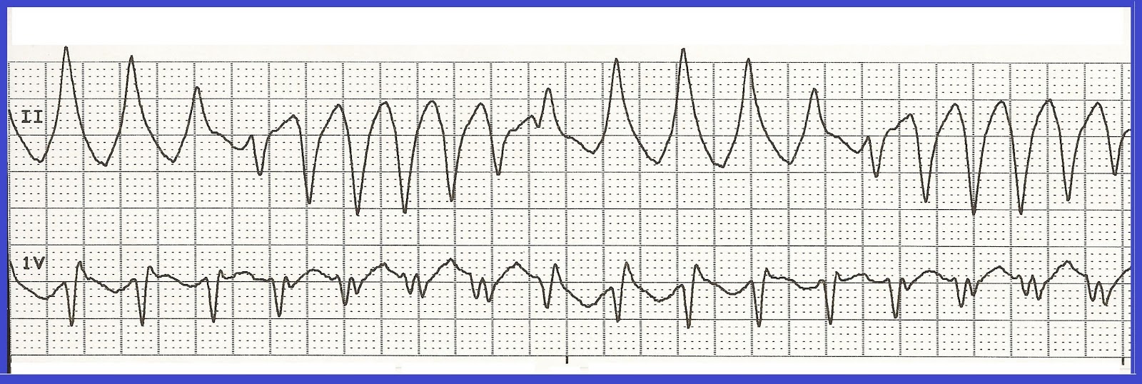 Monomorphic Ventricular Tachycardia