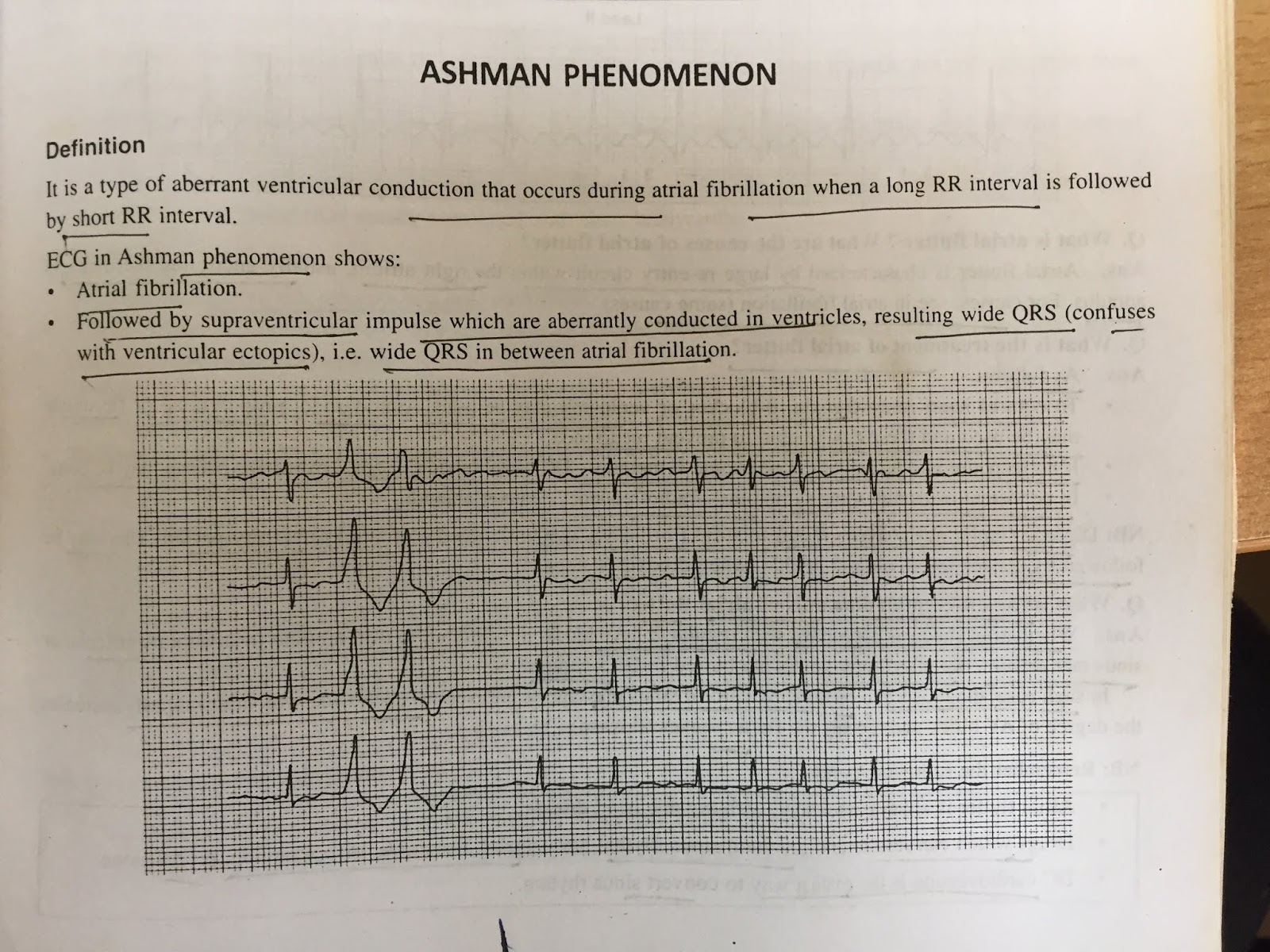 ECG ASHMAN PHENOMENON,ATRIAL FLUTTER,AND VENTRICULAR ECTOPICS
