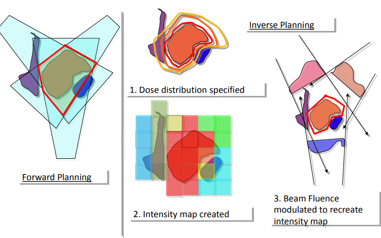 IMRT Planning - Radiologi