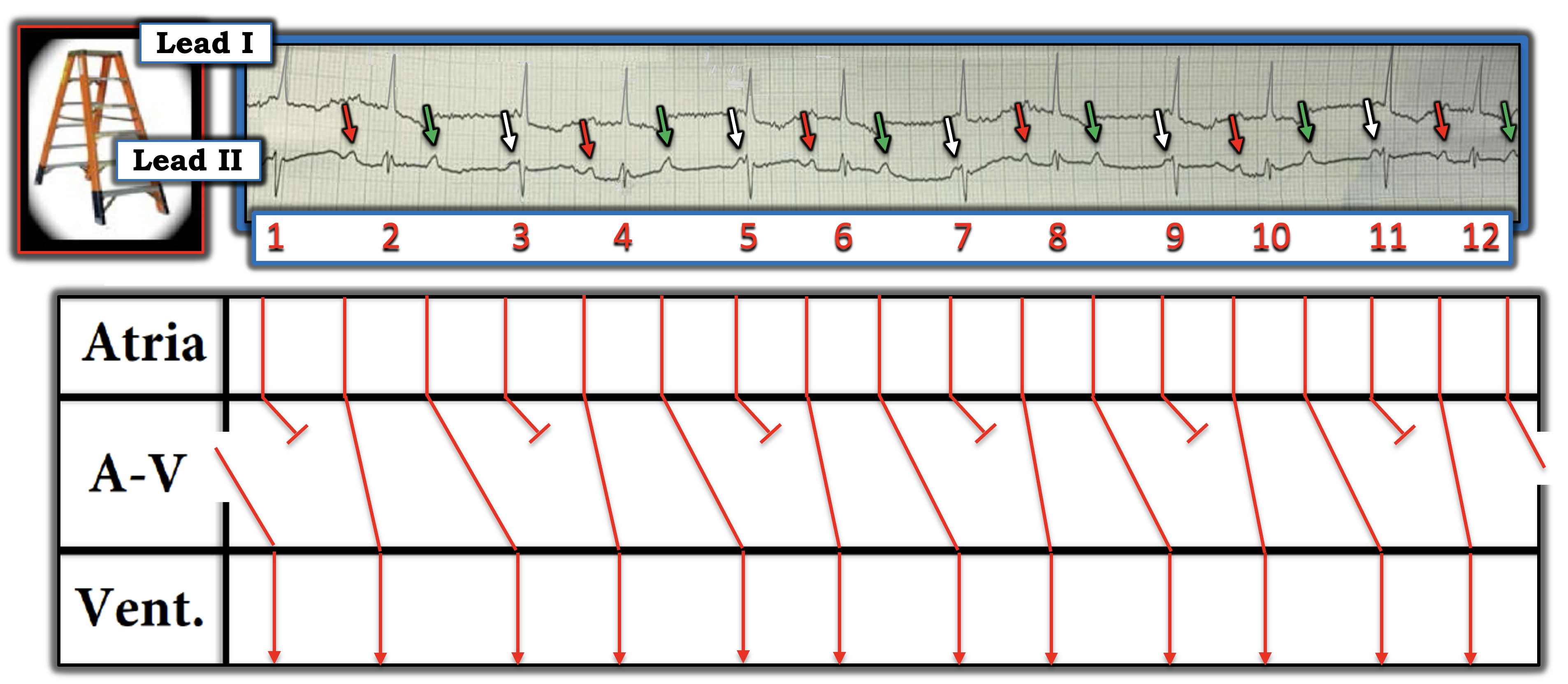 ECG Interpretation: ECG Blog #267 (75): Group Beating and a Changing QRS
