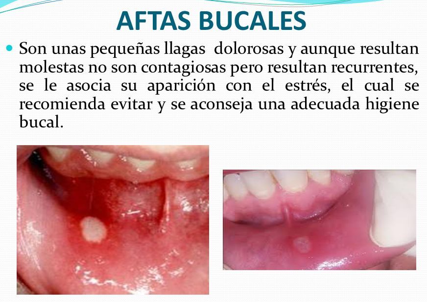 Educar desde la familia: Aftas en la boca, cómo curarlas