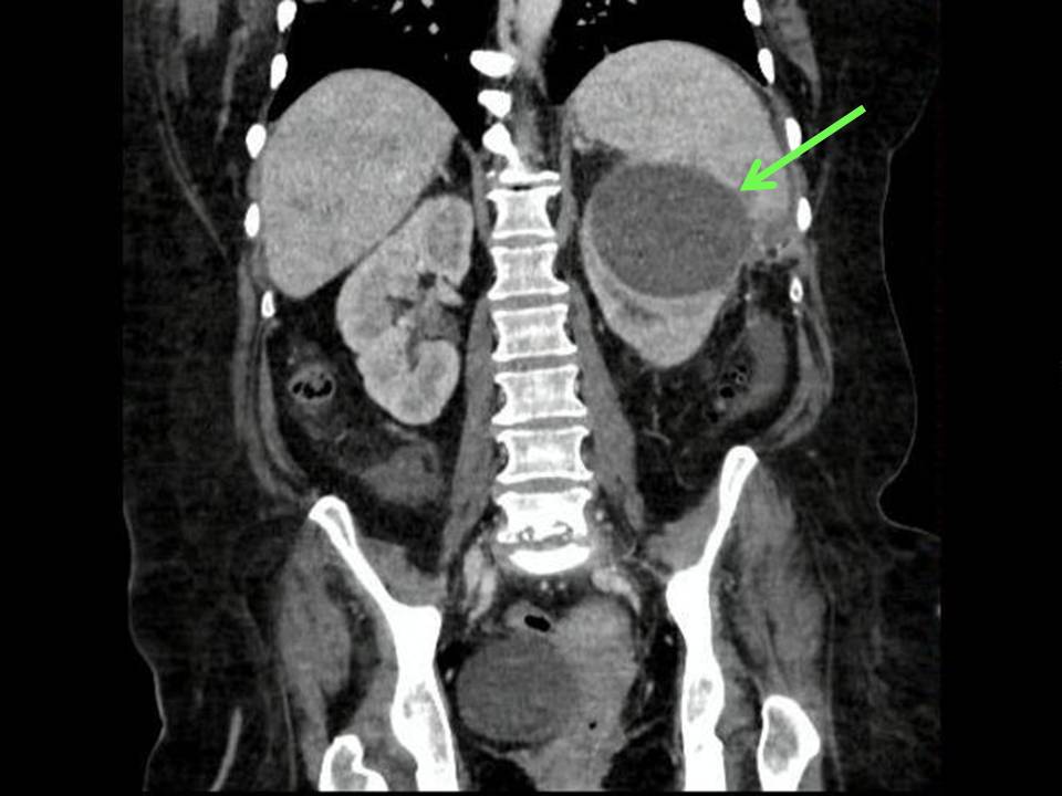 THE PERUVIAN CYTOPATHOLOGY CORNER: ABSCESO RENAL TUBERCULOSO