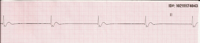 EKG Rhythm Strips 14: Junctional Rhythms