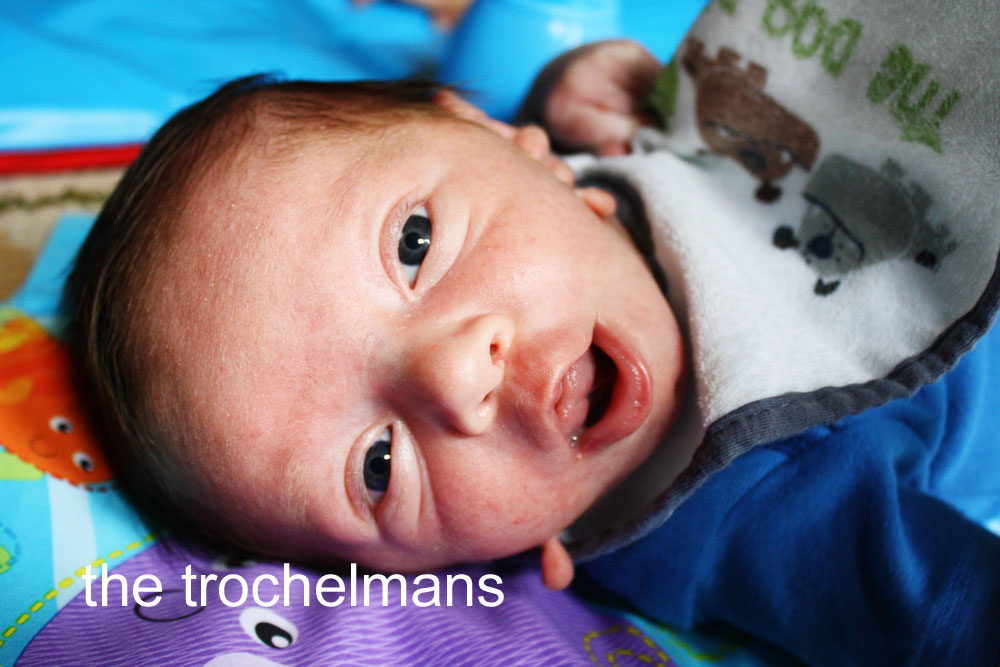 the trochelmans: Skin tag removal on our baby