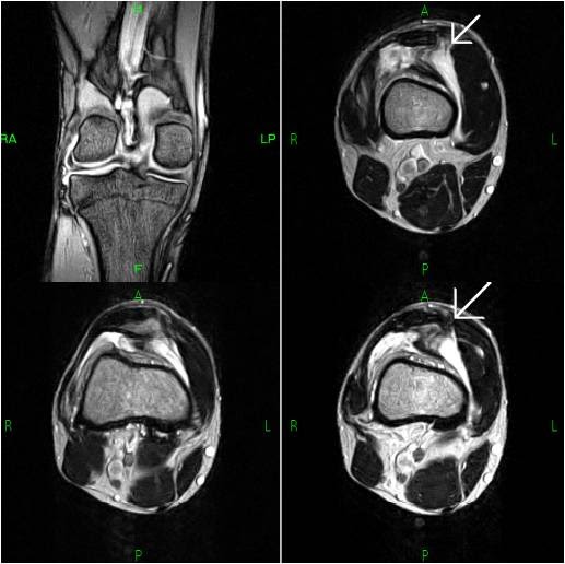Vastus medialis obliquus (VMO) tendinous tear-MRI - Sumer's Radiology Blog