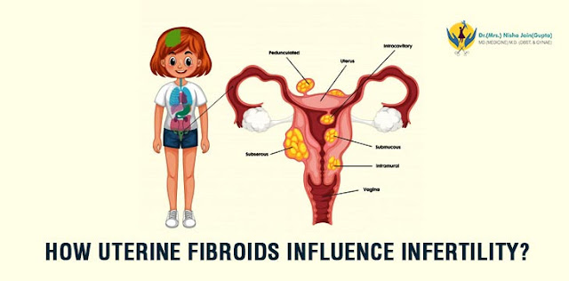 How Uterine Fibroids Influence Infertility?