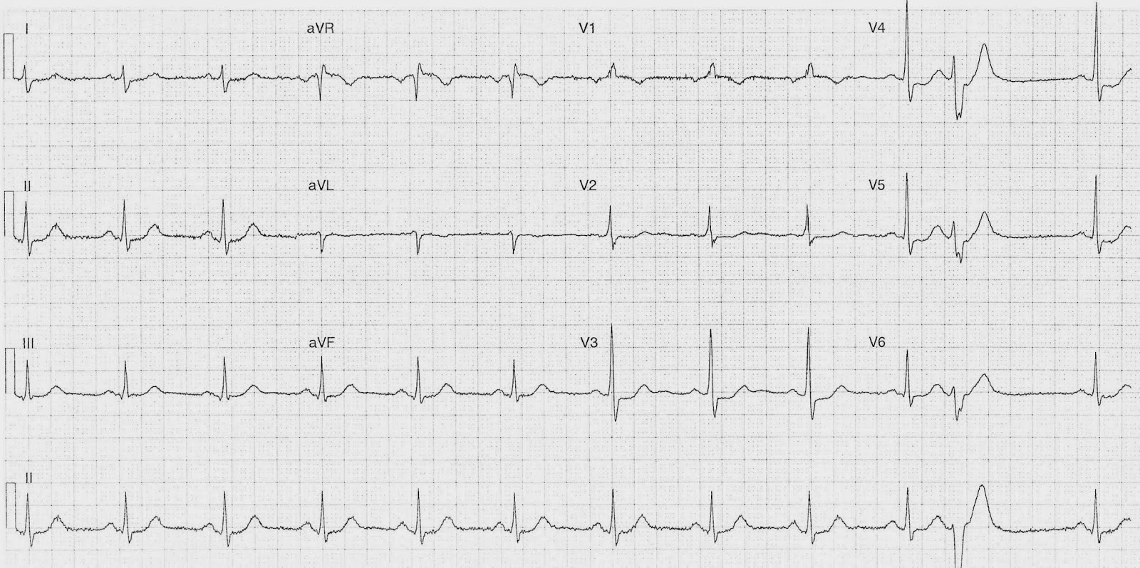ECG of the Week: ECG of the Week - 26th May 2014