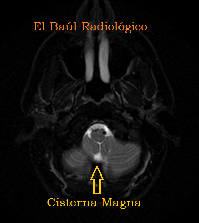 El Baúl Radiológico: ASPECTO DE LA CISTERNA MAGNA EN TOMOGRAFÍA ...